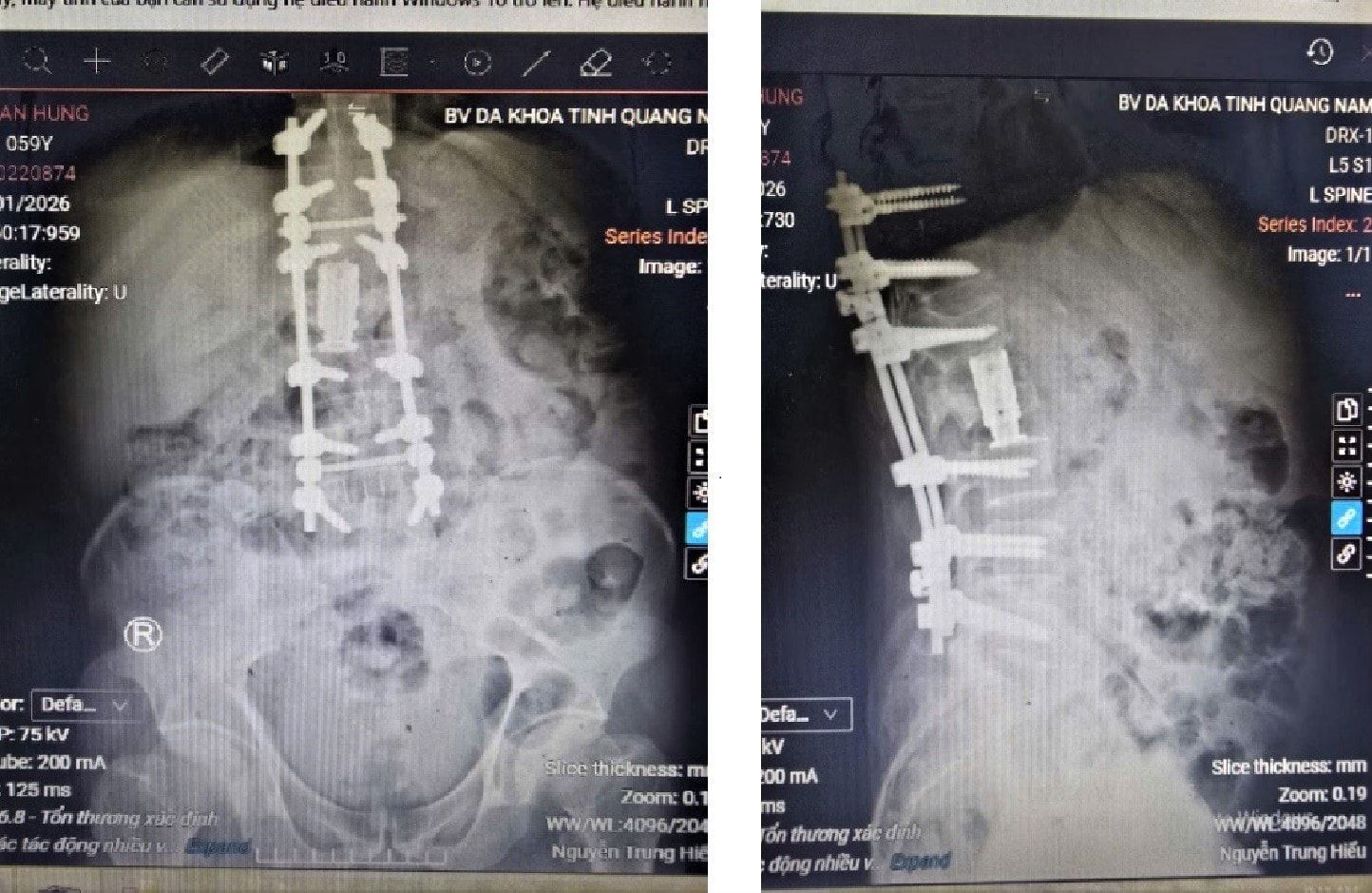 Two-pronged surgery saves patient with complex spinal fracture.